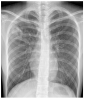 활동성 폐결핵 엑스레이 증례 공동성 결절 결핵 X Ray 소견 네이버 블로그